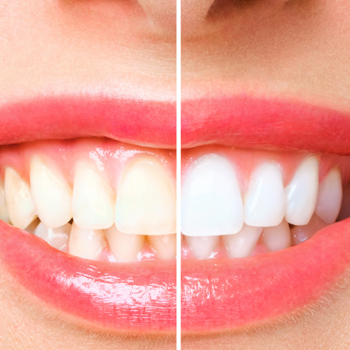 Teeth Whitening – www.beautyhubnj.com